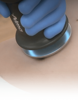 Comparing Soprano Laser Devices - Alma UK